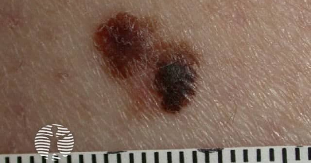 Superficial spreading melanoma image