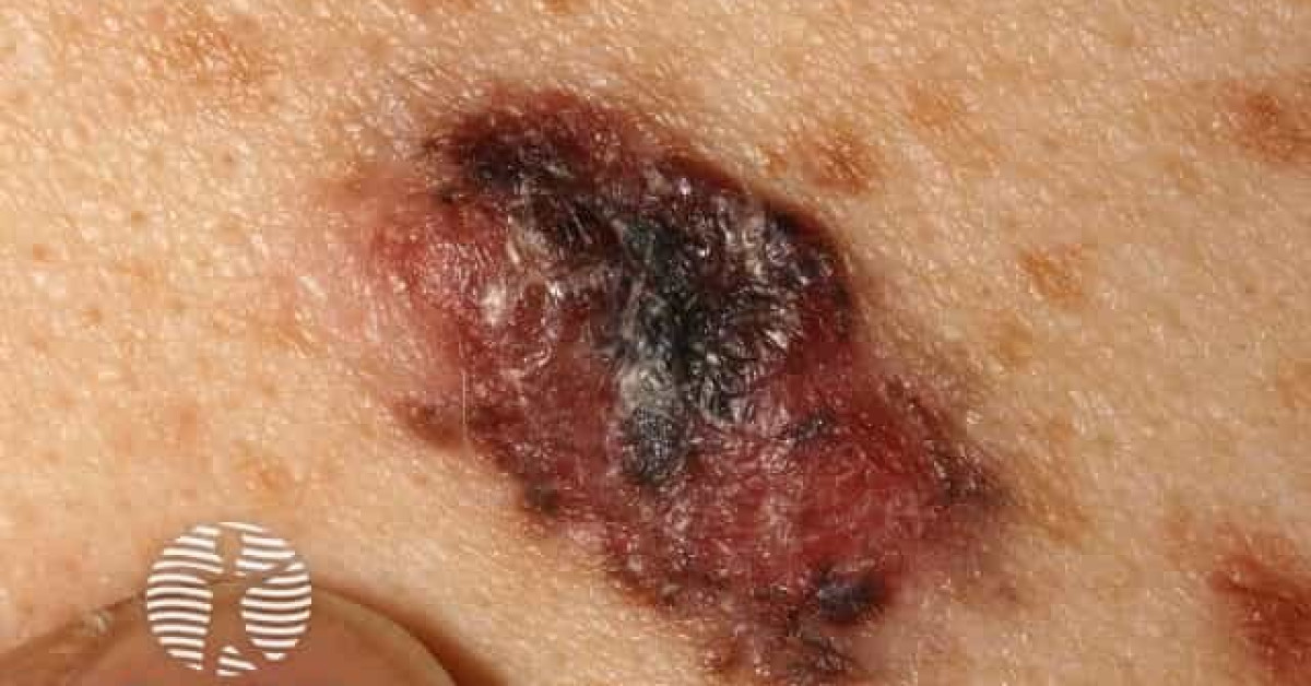 Superficial spreading melanoma image