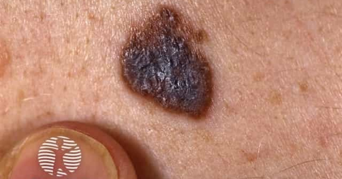 Superficial spreading melanoma image