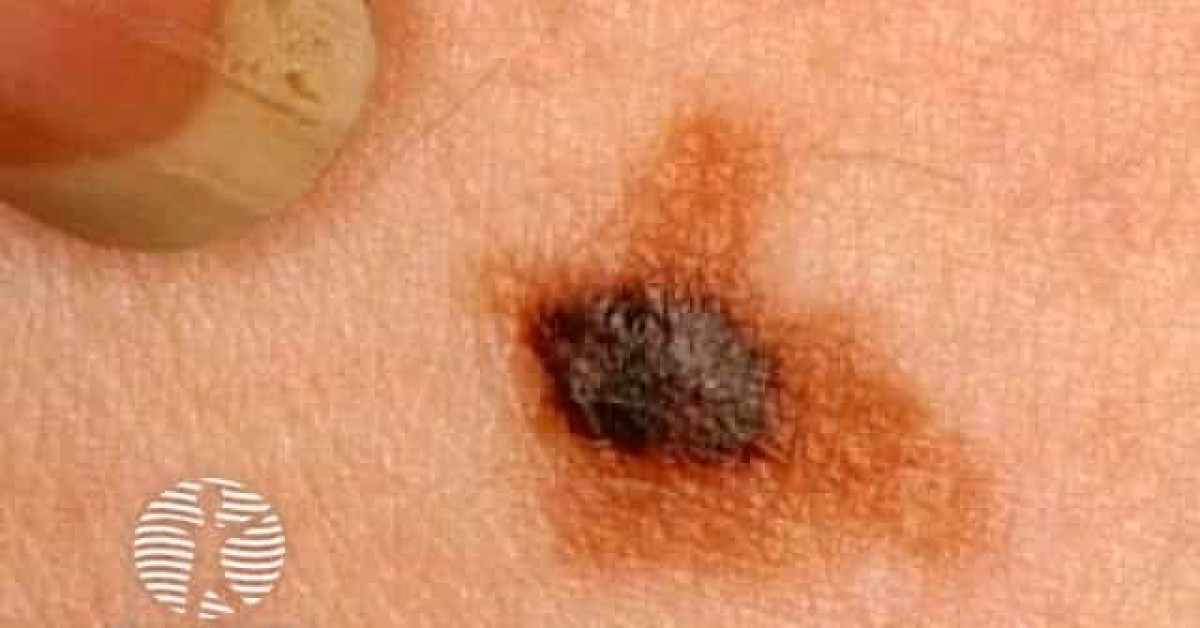 Superficial spreading melanoma image