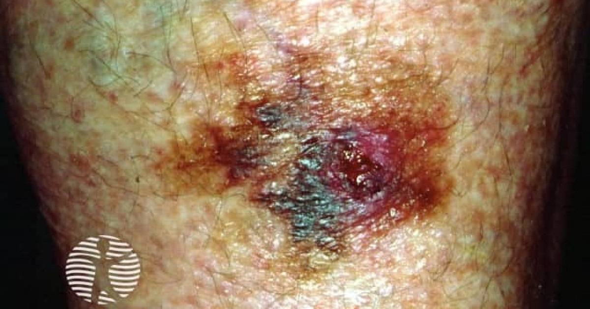 Superficial spreading melanoma image