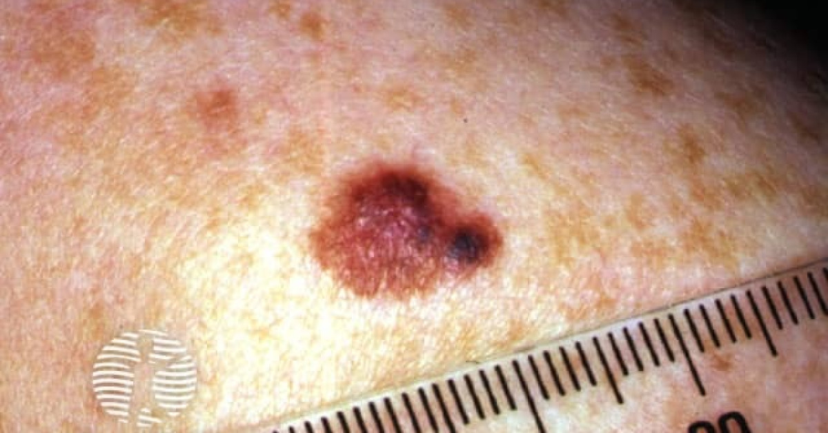 Superficial spreading melanoma image
