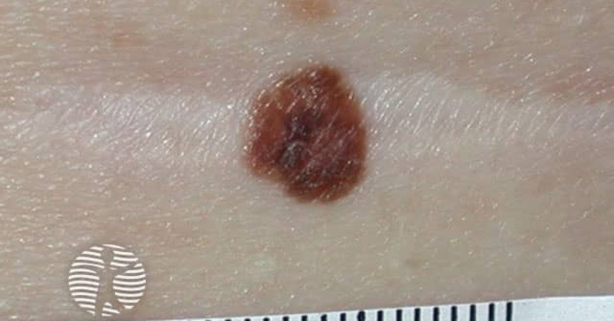 Superficial spreading melanoma image