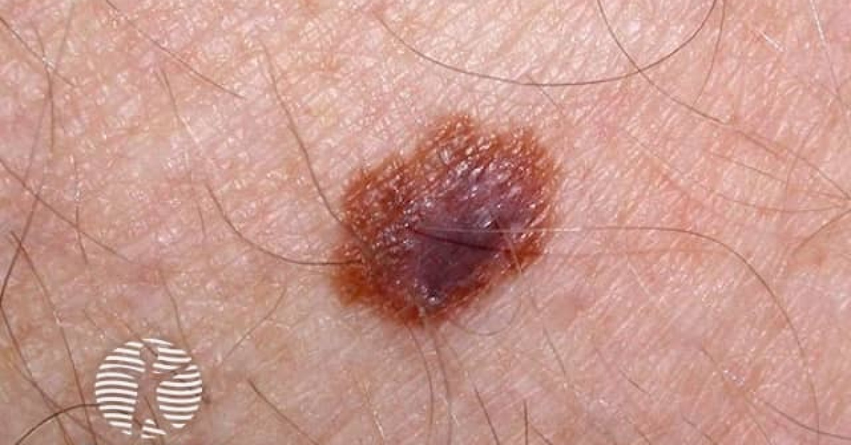Superficial spreading melanoma image