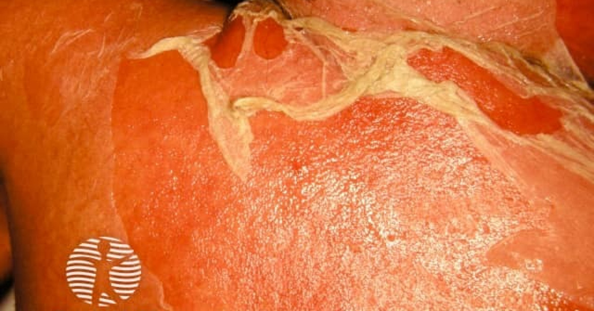 Staphylococcal scalded skin syndrome image