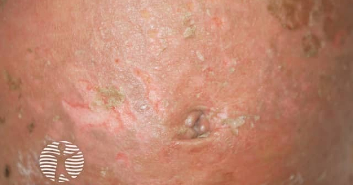Staphylococcal scalded skin syndrome image