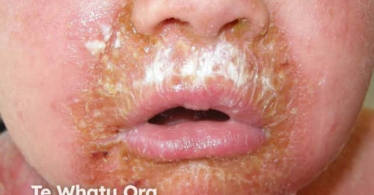 Staphylococcal scalded skin syndrome image