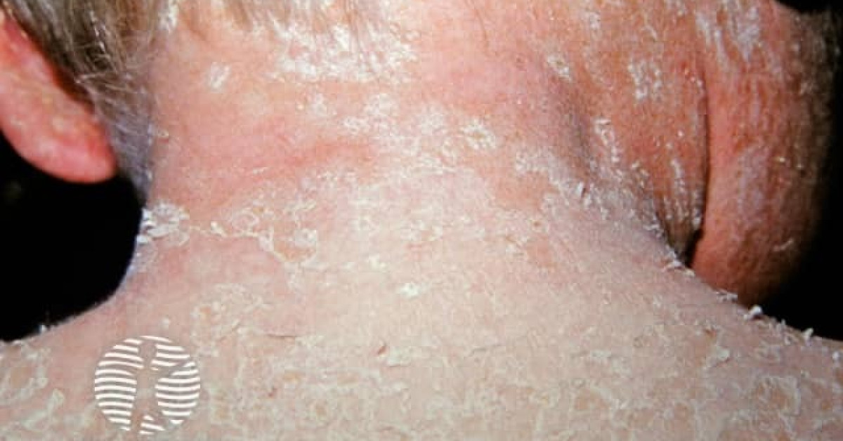 Staphylococcal scalded skin syndrome image