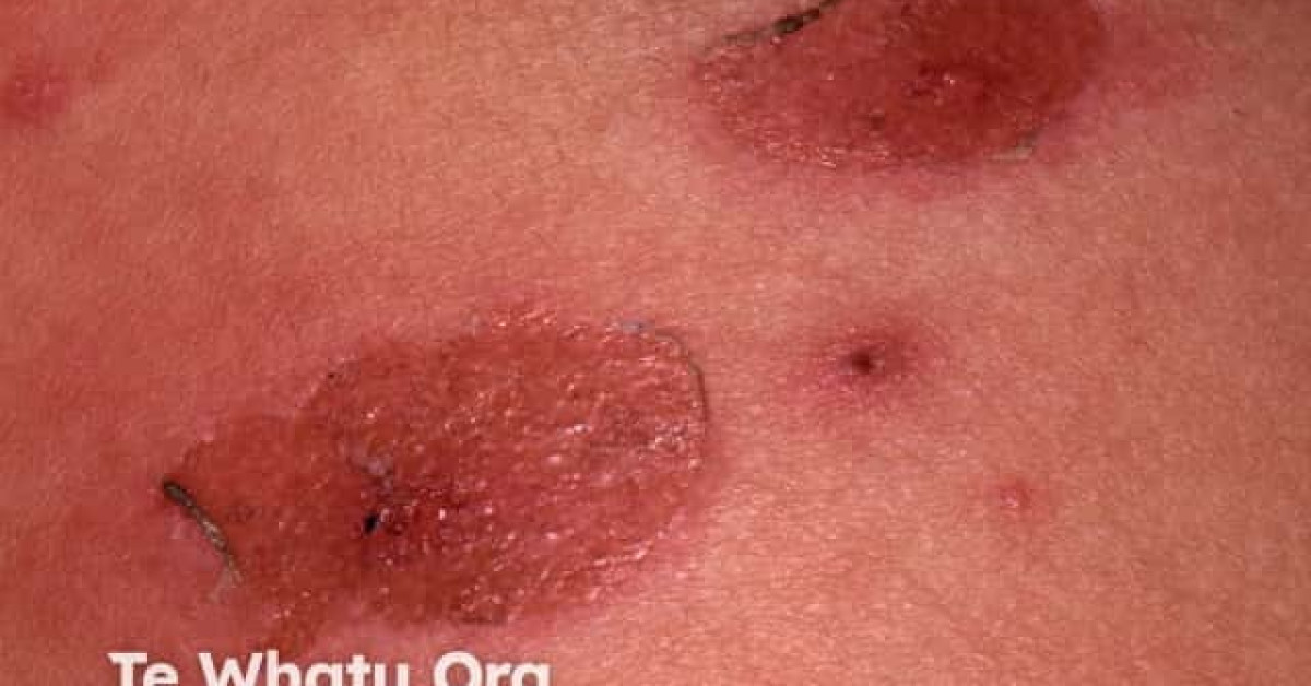 Staphylococcal scalded skin syndrome image