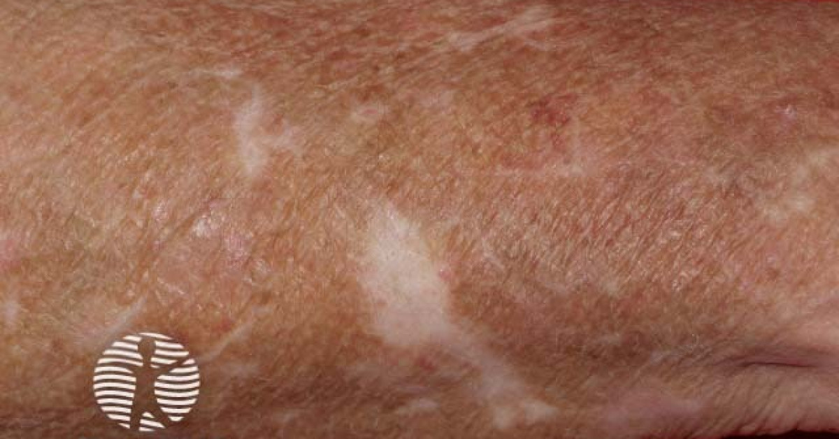 Stellate pseudoscarring image
