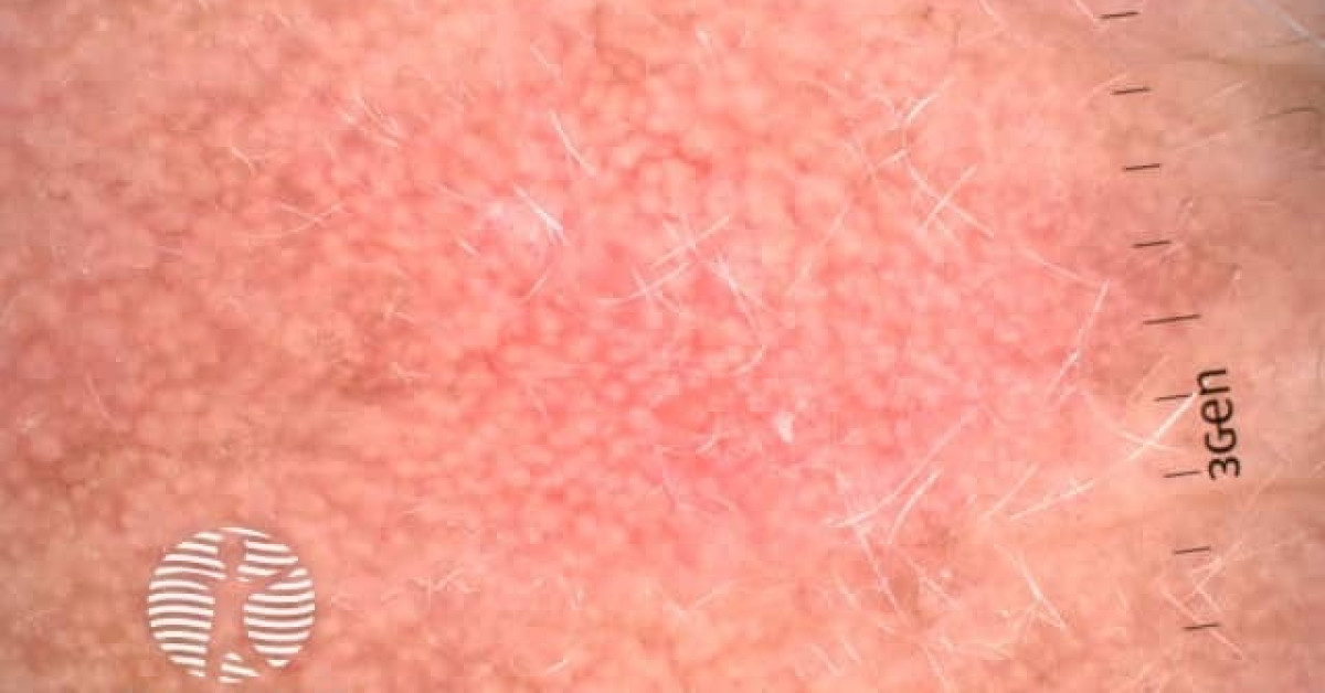 Strawberry pattern dermoscopy of facial actinic keratosis image