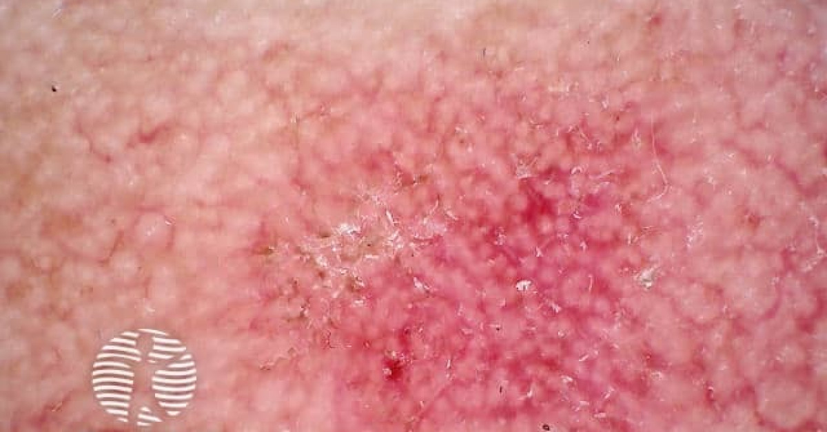 Strawberry pattern dermoscopy of facial actinic keratosis image