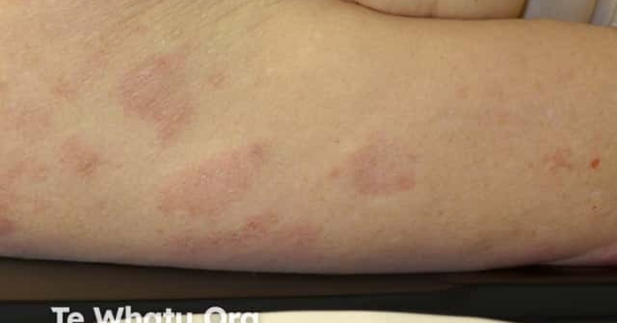 Subacute lupus erythematosus image