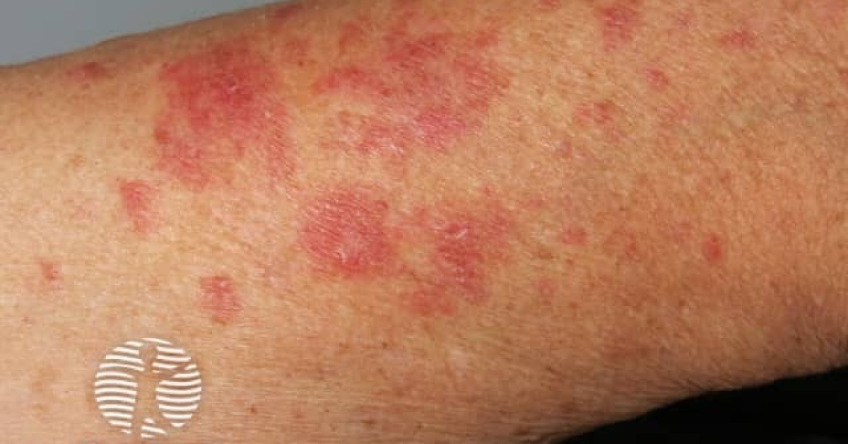 Subacute lupus erythematosus image