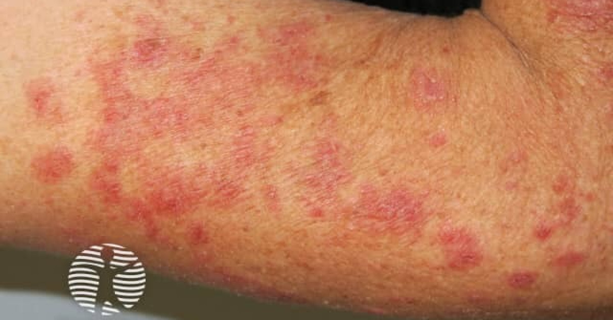 Subacute lupus erythematosus image