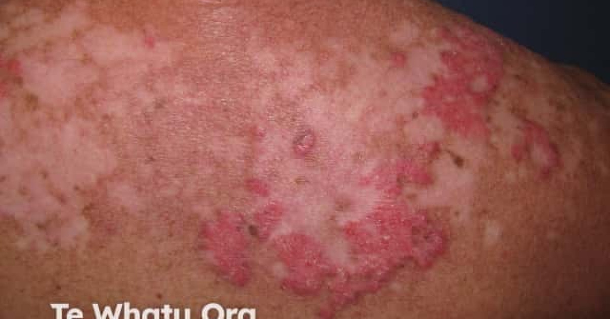 Subacute lupus erythematosus image