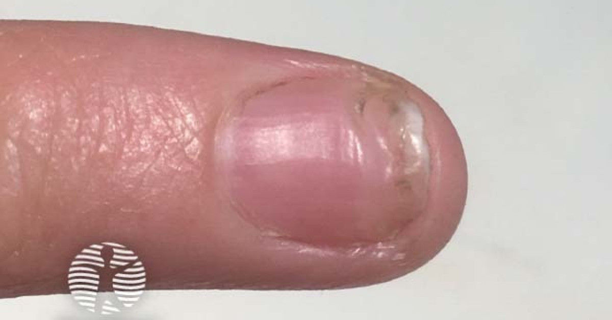 Nail recovery after trauma image