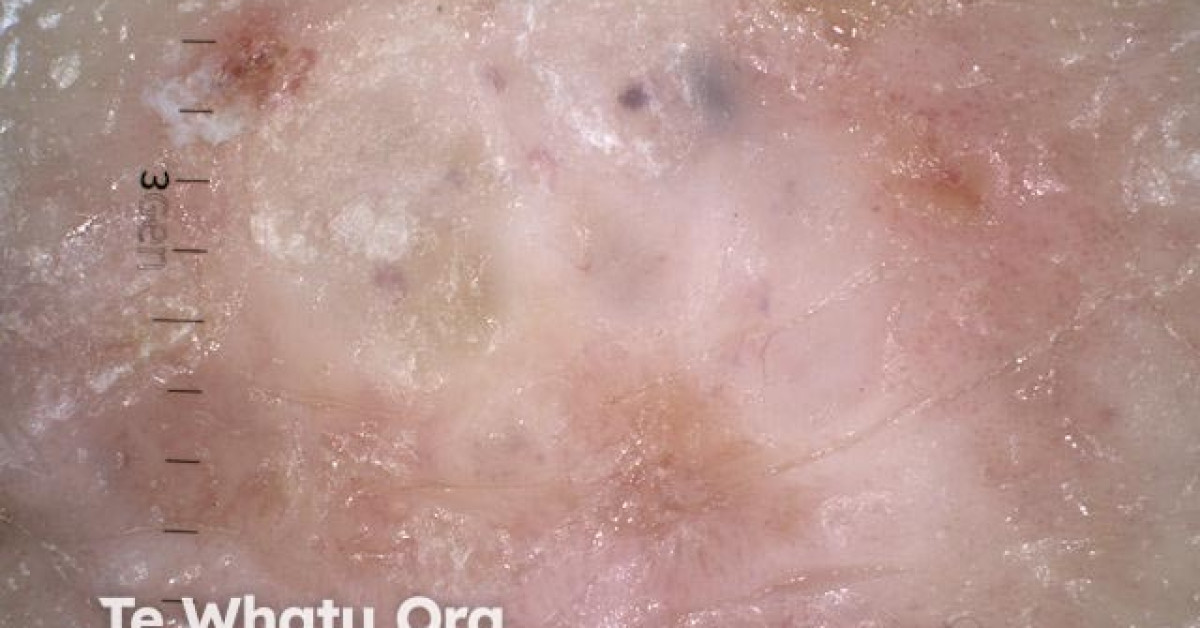 Superficial basal cell carcinoma nonpolarised dermoscopy view image