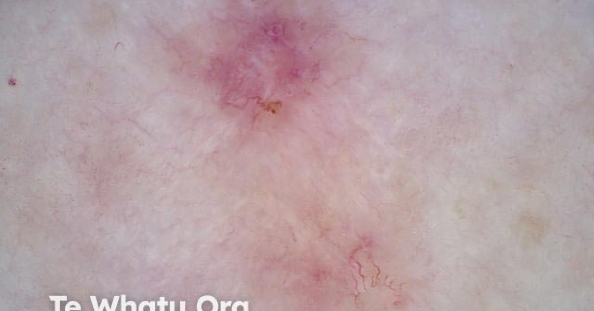 Superficial basal cell carcinoma polarised dermoscopy view image