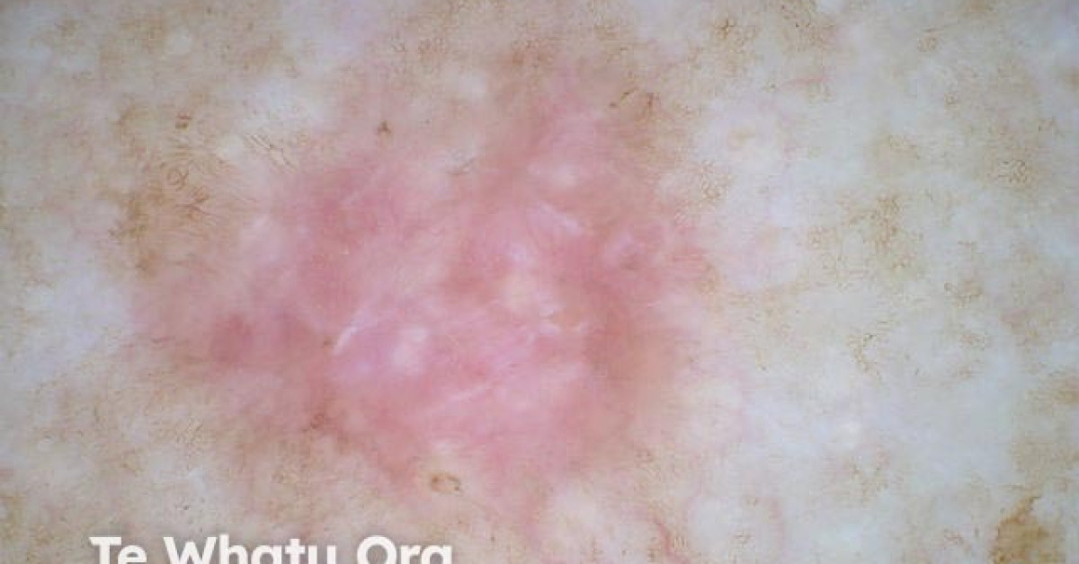 Superficial basal cell carcinoma polarised dermoscopy view image