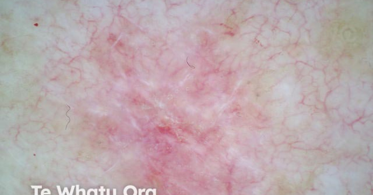 Superficial basal cell carcinoma polarised dermoscopy view image