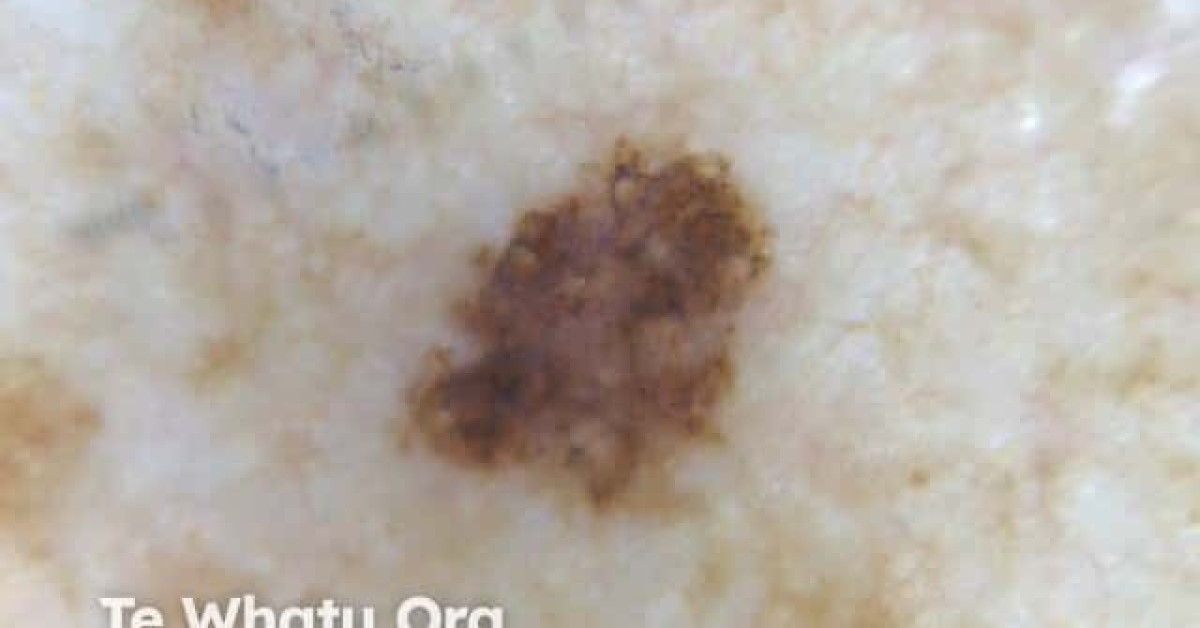 Superficial spreading melanoma image