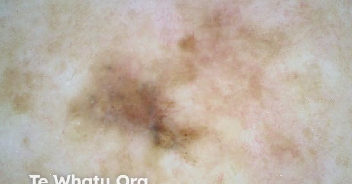 Superficial spreading melanoma, Breslow 0.7mm, arising within a ...