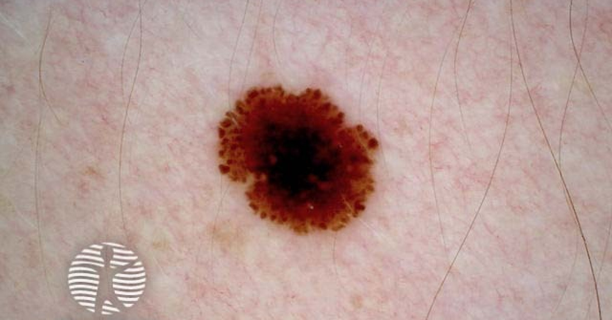 Superficial spreading melanoma, Breslow 0.4 mm, polarised dermoscopy ...
