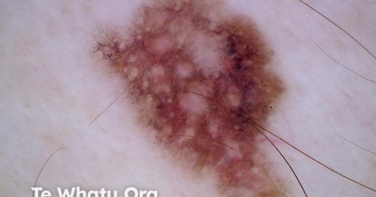 DermNet® - Superficial spreading melanoma, Breslow 0.4 mm, polarised ...