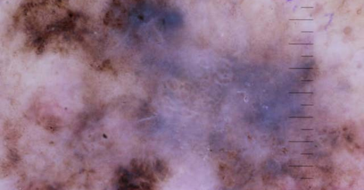 Superficial spreading melanoma, Breslow 0.6 mm, nonpolarised dermoscopy ...