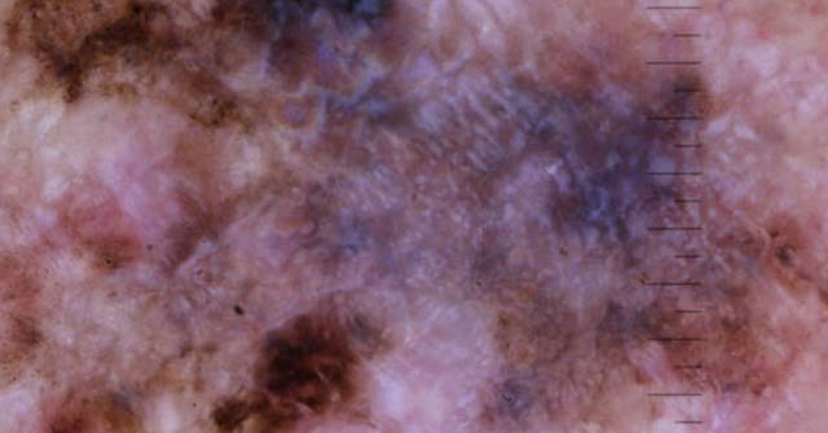 Superficial spreading melanoma, Breslow 0.6 mm, polarised dermoscopy ...