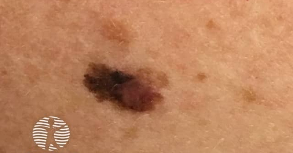 Superficial spreading melanoma image