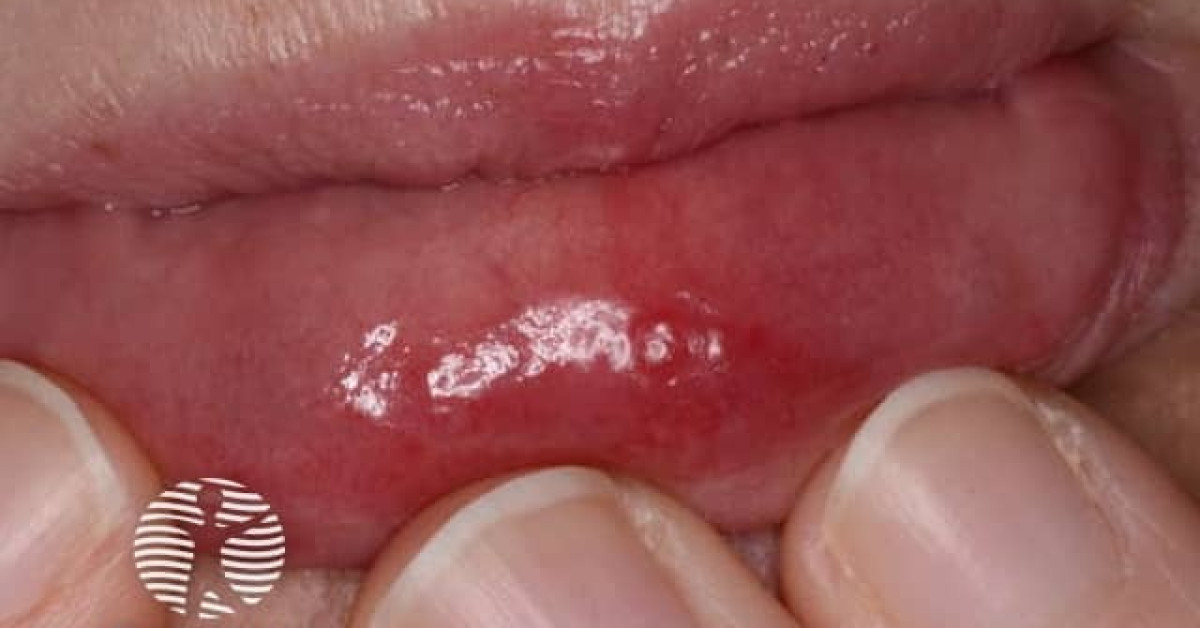 Sweet syndrome affecting lip image