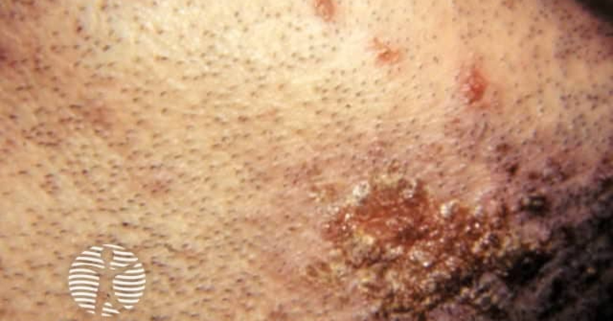 Sycosis barbae image