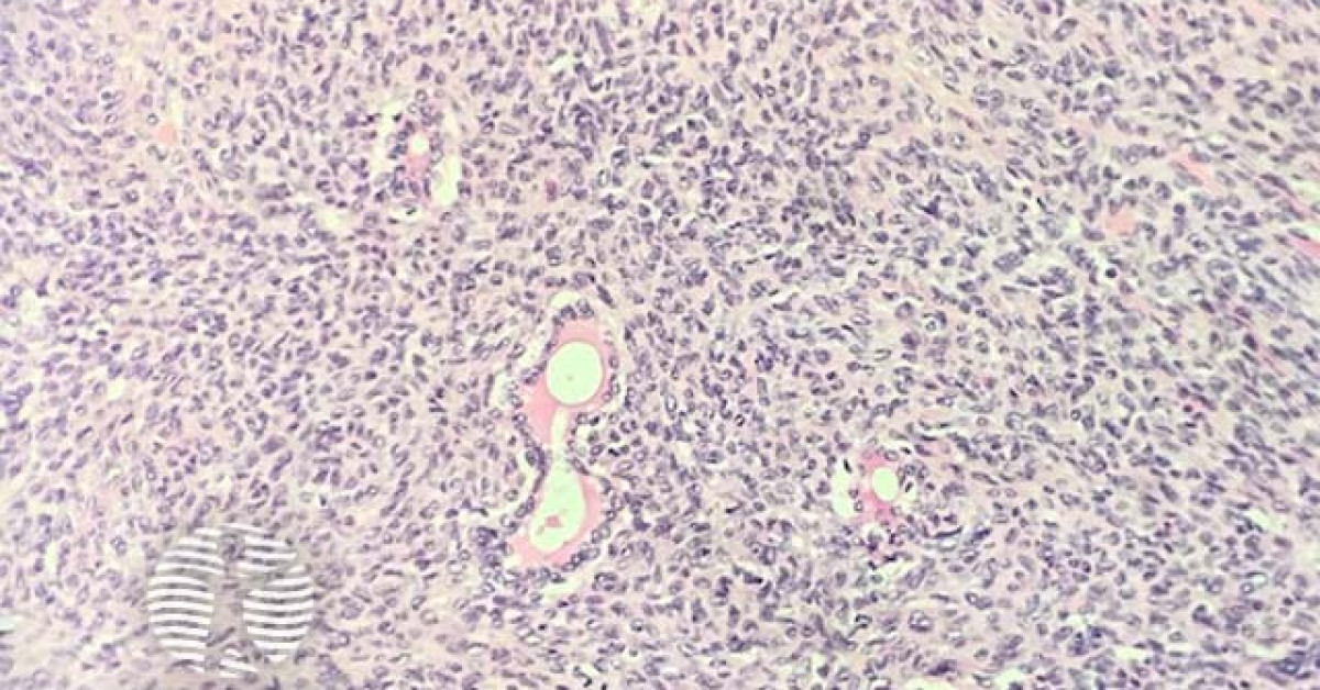 Synovial sarcoma image