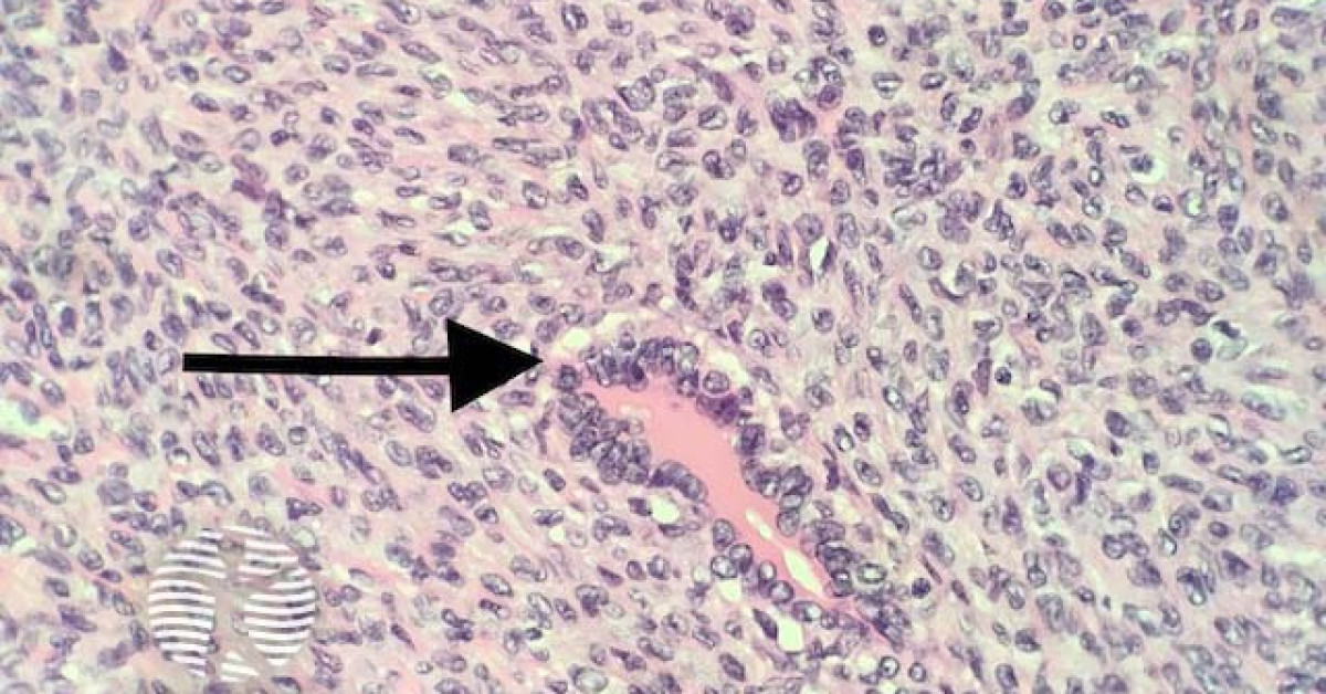 Synovial sarcoma image