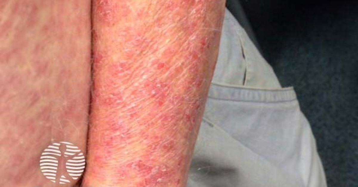 DermNet® - Secondary syphilis image