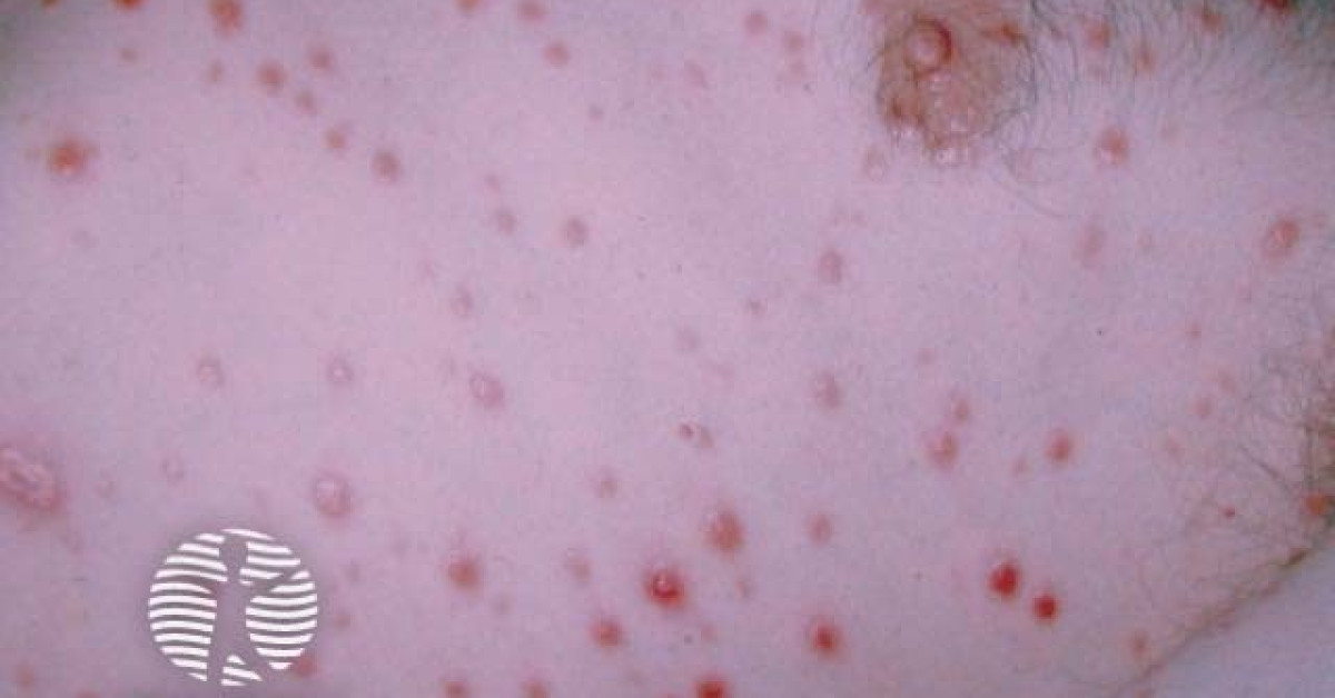 Secondary Syphilis Image