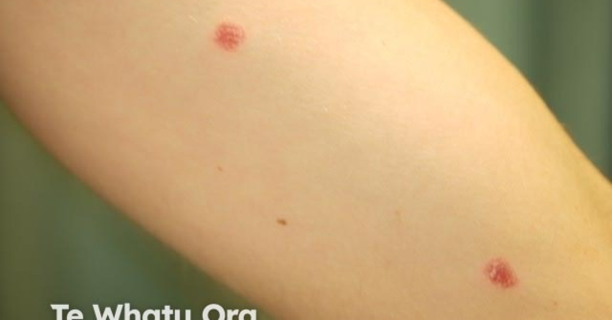 Secondary syphilis image