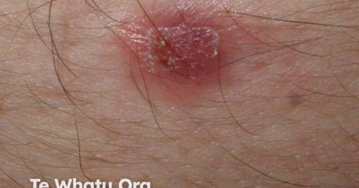 Secondary syphilis image