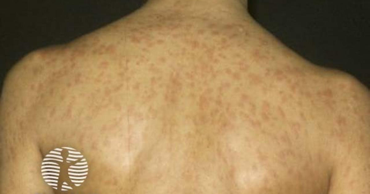 Secondary syphilis image