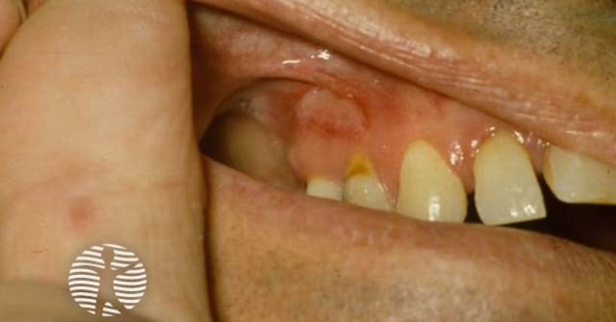 Secondary Syphilis Image