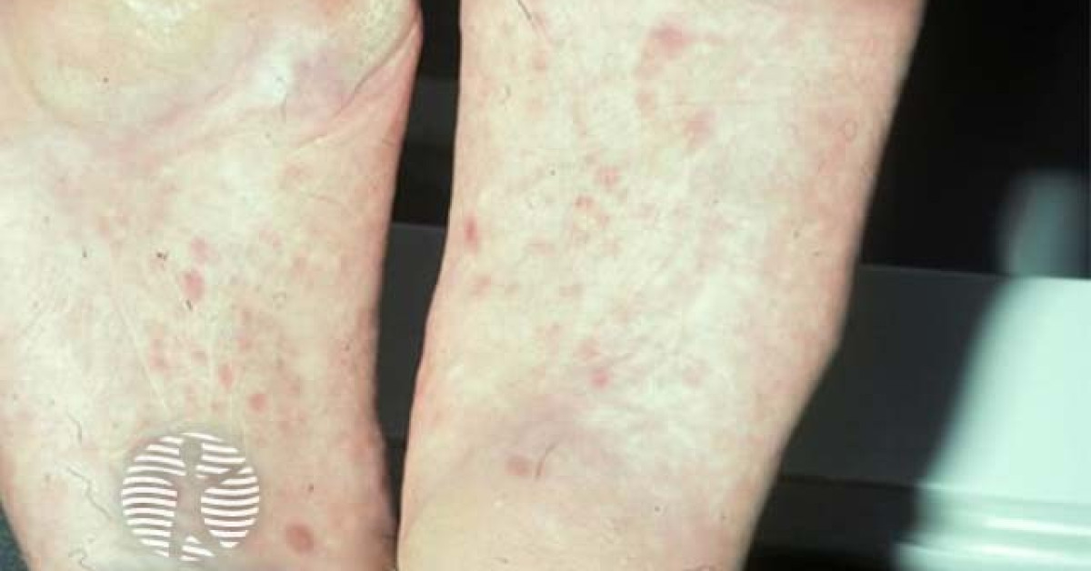 Secondary syphilis image