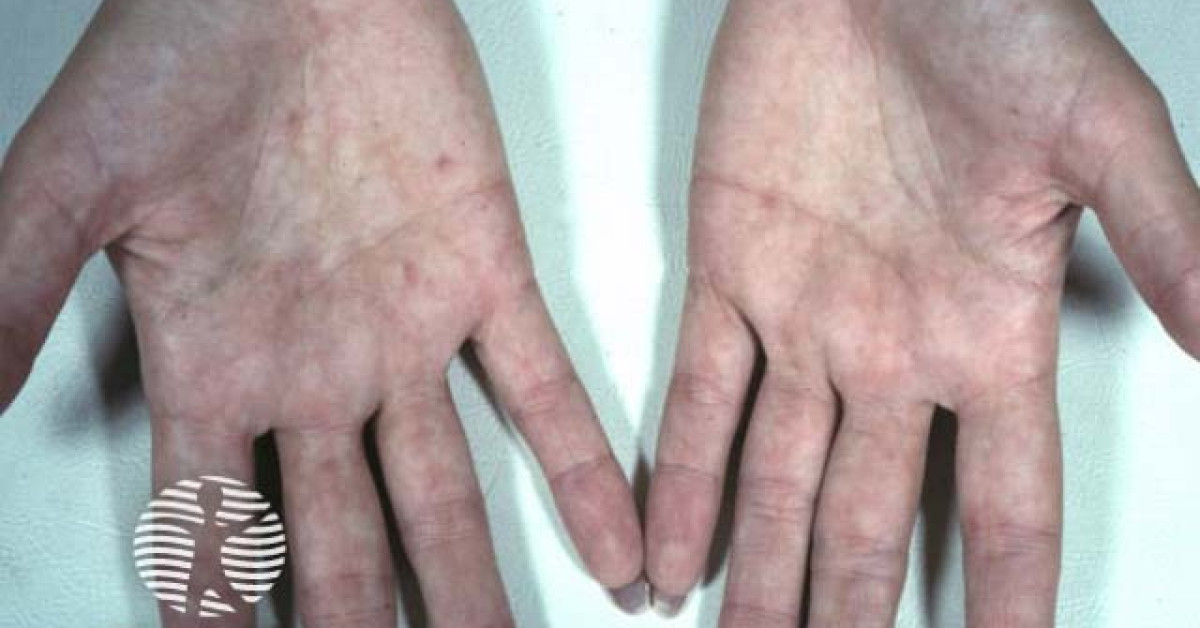 Secondary syphilis image