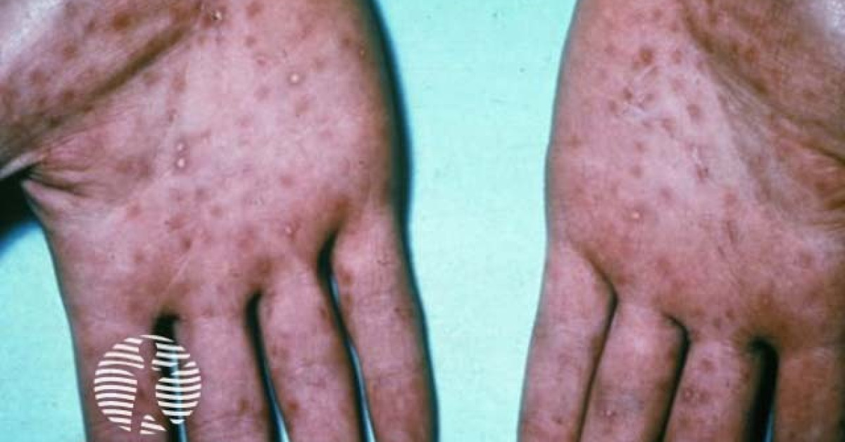 Secondary Syphilis Image