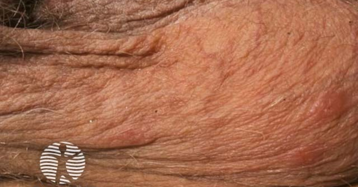 Secondary syphilis image