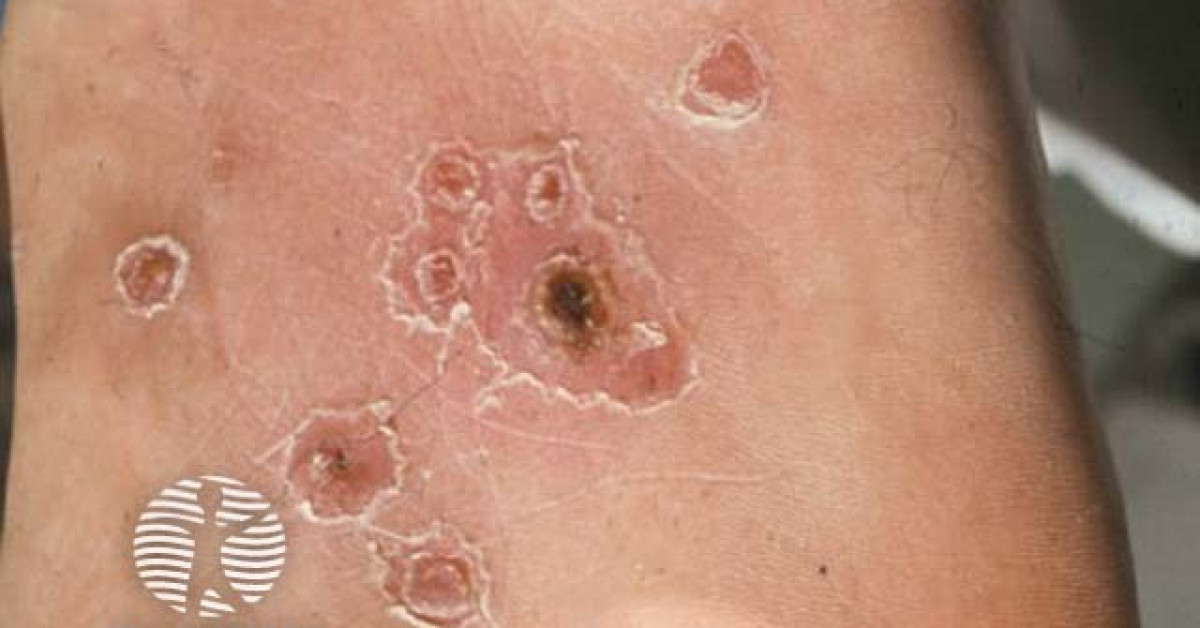 Secondary syphilis image