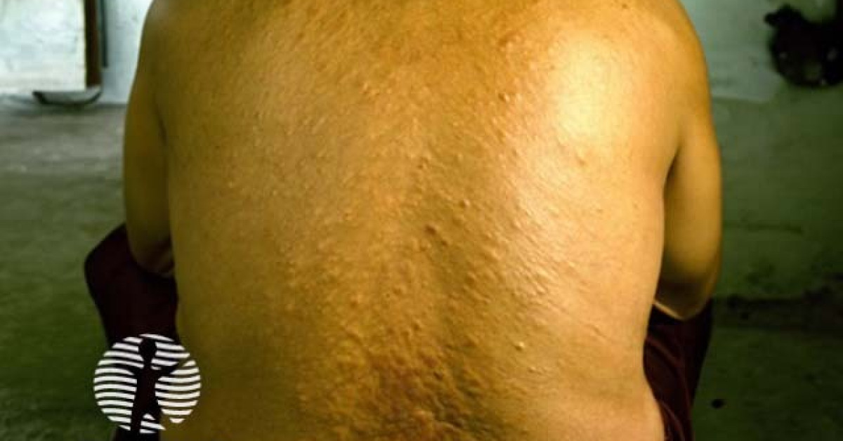 Secondary syphilis image