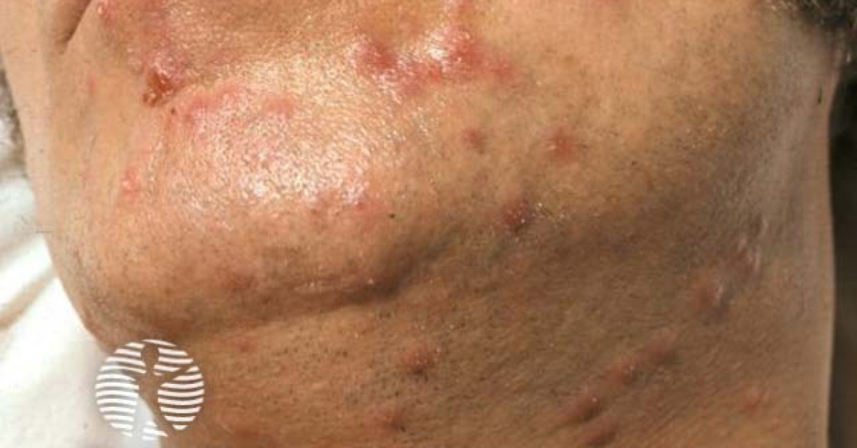 Secondary syphilis image