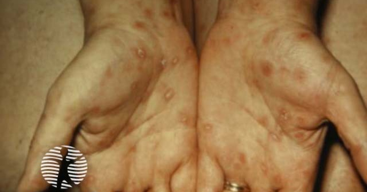 Secondary syphilis image